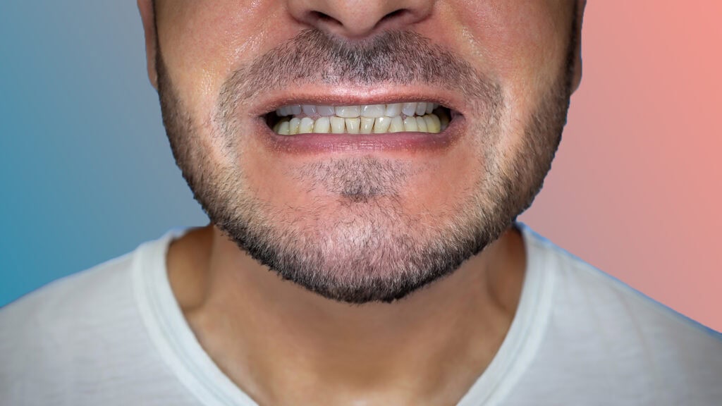 Crooked Teeth: Why Do They Happen and How to Fix Them? | İstanbul ...