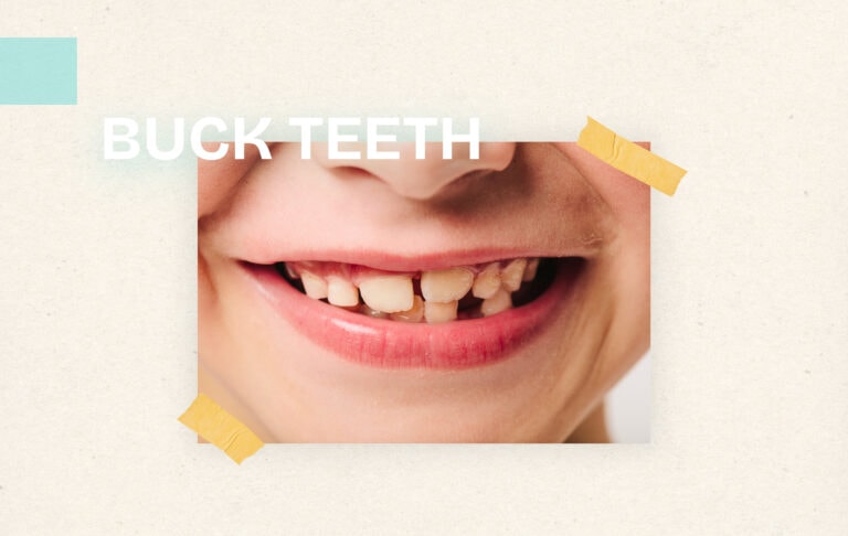 Buck Teeth (Overjet/Protrusion): What They Are, Why They Happen, and ...